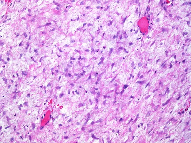 Extra-Abdominal Fibromatosis (Desmoid Tumor)