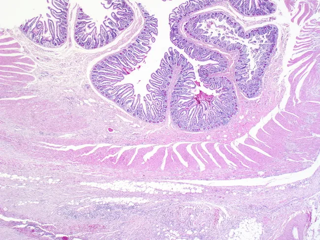 Mesenteric Fibromatosis in Gardner Syndrome