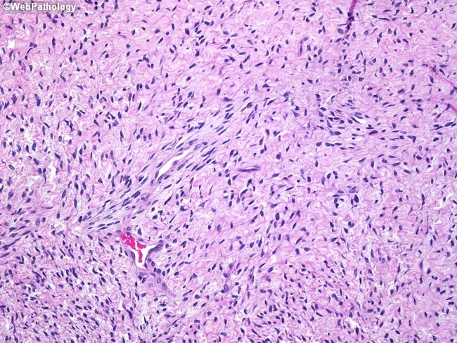 Fibrosarcoma