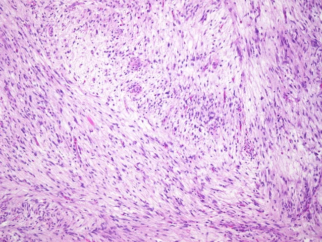 Fibrosarcoma, Myxoid type (Myxofibrosarcoma)