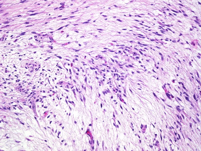 Fibrosarcoma, Myxoid type (Myxofibrosarcoma)