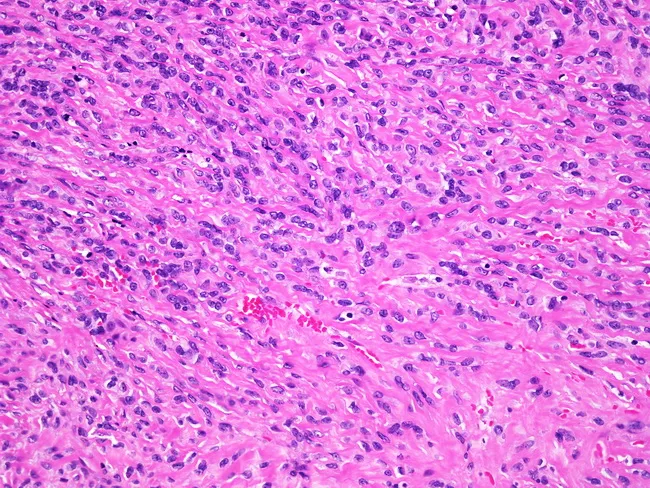 Sclerosing Epithelioid Fibrosarcoma