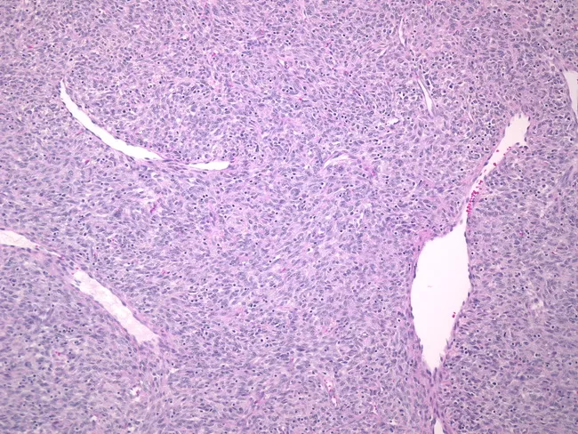 Congenital/Infantile Fibrosarcoma