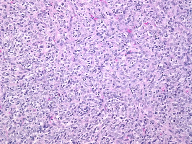 Congenital/Infantile Fibrosarcoma