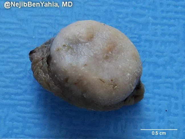 Juvenile Xanthogranuloma