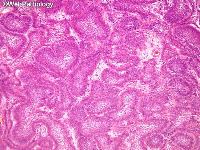 Ameloblastoma : Basaloid Pattern