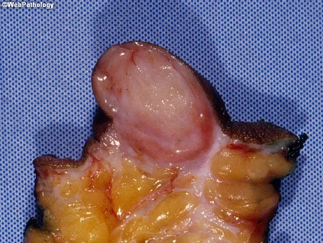 dermatofibrosarcoma protuberans hand