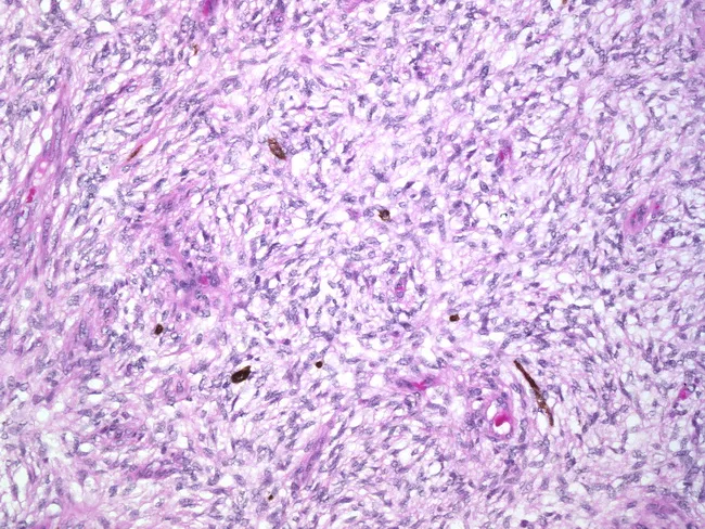 dermatofibrosarcoma protuberans pathology