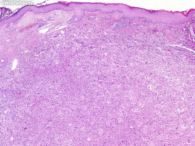 Atypical Fibroxanthoma