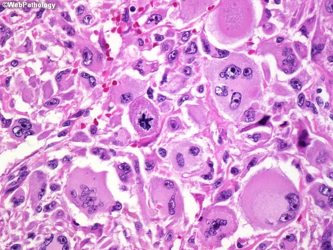 Atypical Fibroxanthoma