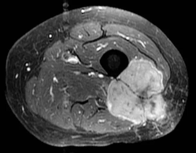 Undiff. Pleomorphic Sarcoma : Imaging