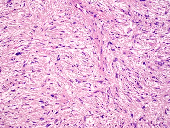 Undiff. Pleomorphic Sarcoma: Microscopic