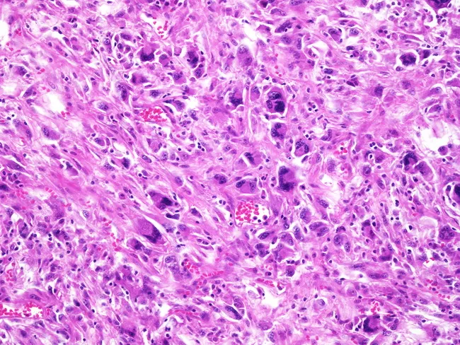 Undiff. Pleomorphic Sarcoma: Immunohistochemistry