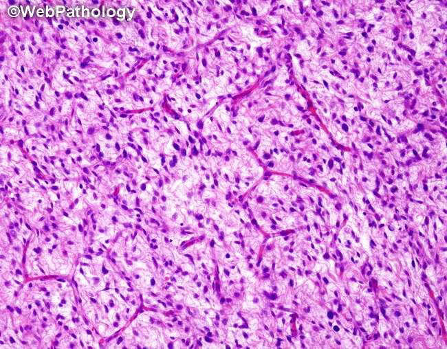 Myxofibrosarcoma : Morphology