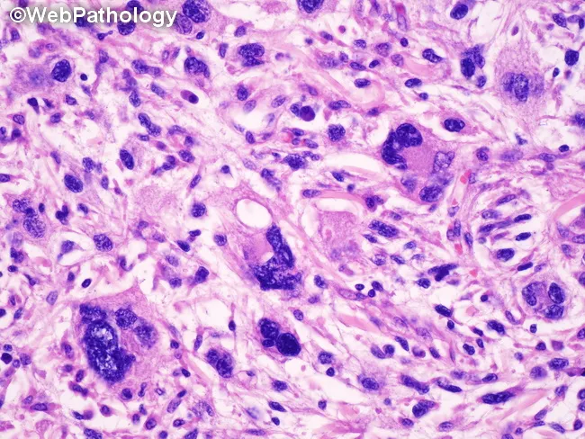 Undiff. Pleomorphic Sarcoma : Differential Diagnosis