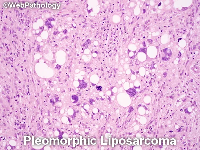 Undiff. Pleomorphic Sarcoma : Differential Diagnosis