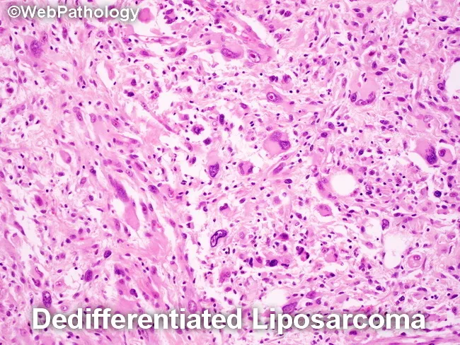 Undiff. Pleomorphic Sarcoma : Differential Diagnosis