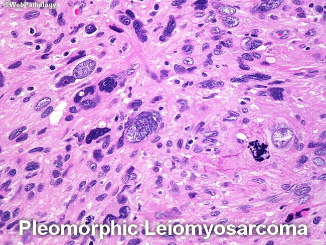 Undiff. Pleomorphic Sarcoma : Differential Diagnosis