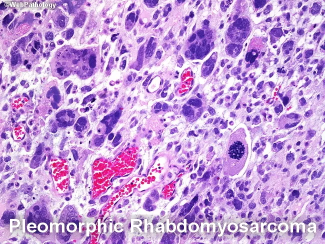 Undiff Pleomorphic Sarcoma Differential Diagnosis