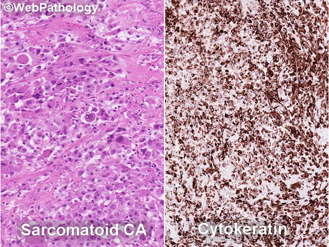 Undiff. Pleomorphic Sarcoma : Differential Diagnosis
