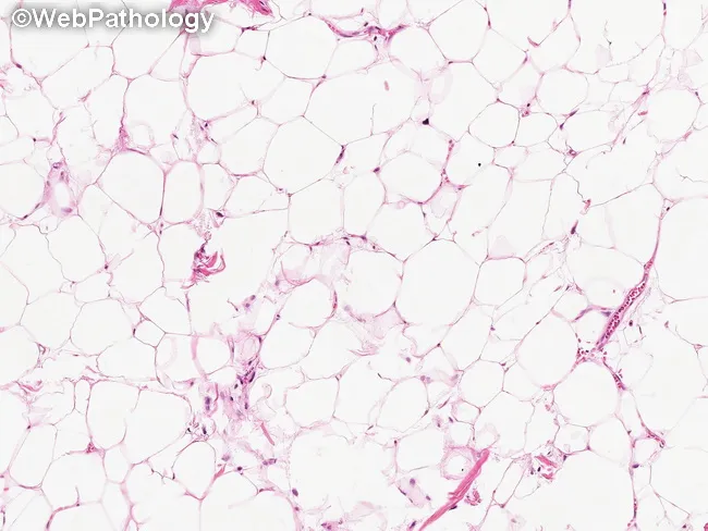 Lipoma : Microscopic Features