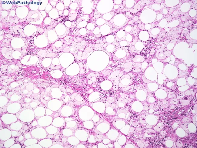 Lipoma : Fat Necrosis