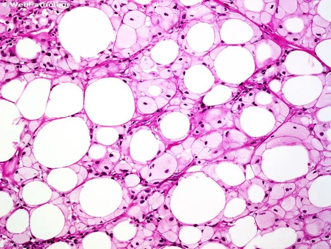 Lipoma : Fat Necrosis