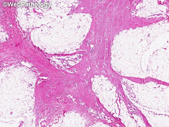Fibrolipoma