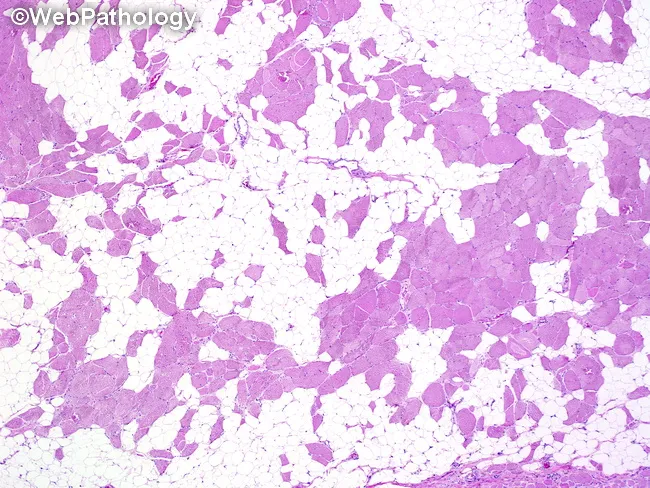 Intramuscular Lipoma