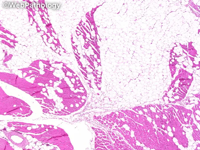 Intramuscular Lipoma