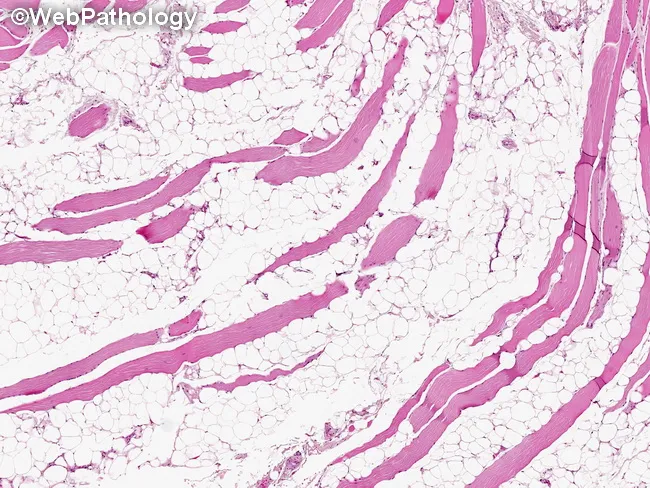 Intramuscular Lipoma