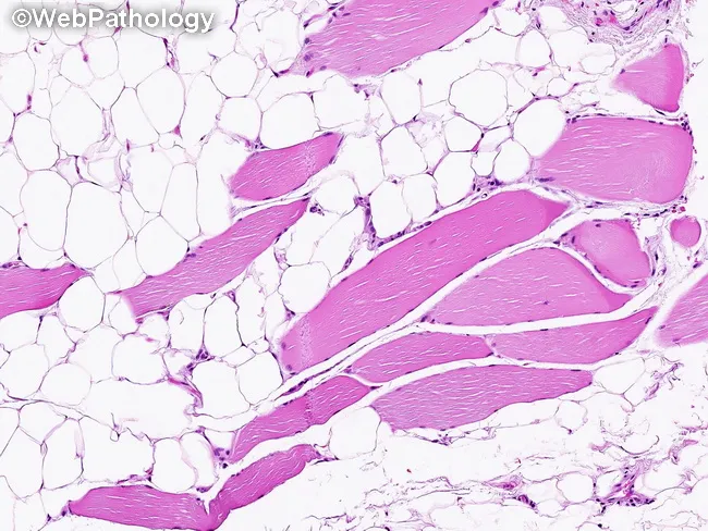 Intramuscular Lipoma