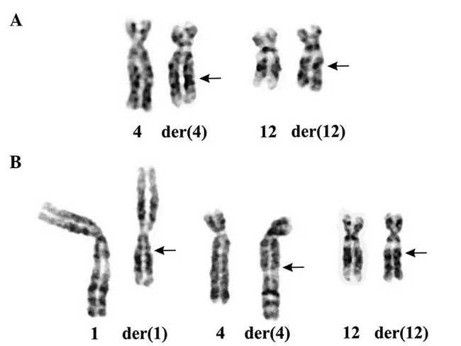 Lipoma Cytogenetics