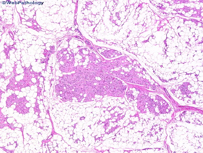 Angiolipoma : Introduction