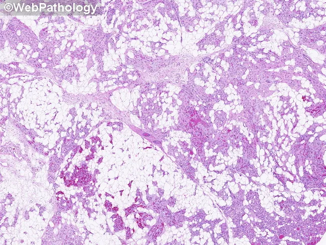Angiolipoma : Clinical Features