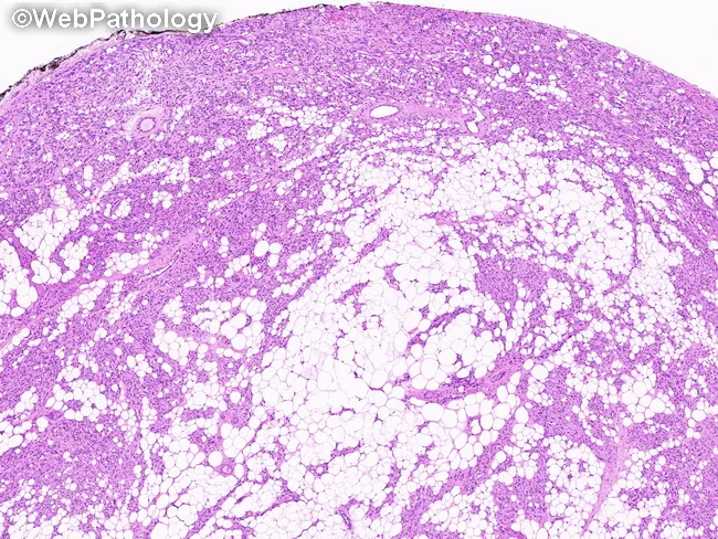 Angiolipoma : Pathogenesis