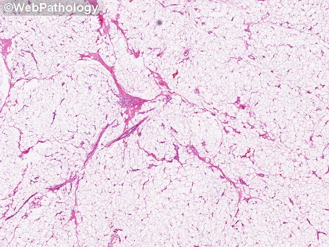 Angiolipoma : Microscopic Features