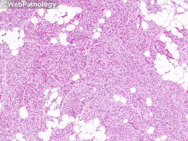 Cellular Angiolipoma