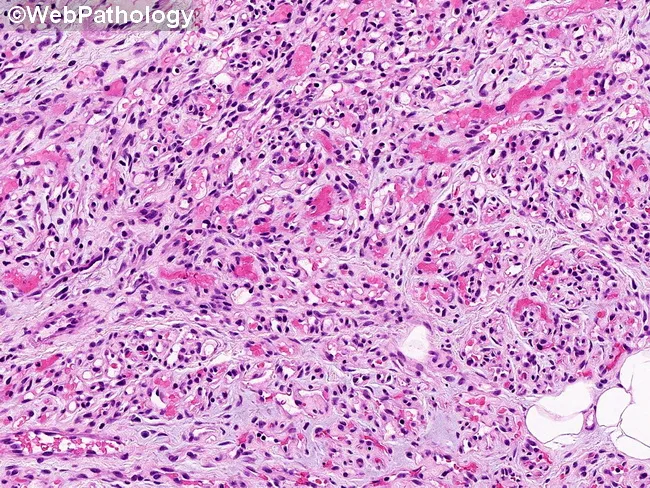 Cellular Angiolipoma