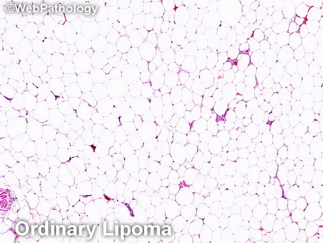 Angiolipoma : Differential Diagnosis