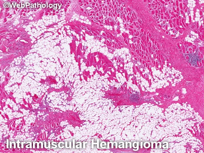 Angiolipoma : Differential Diagnosis