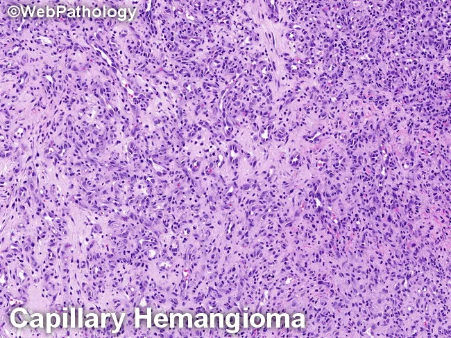 Angiolipoma : Differential Diagnosis