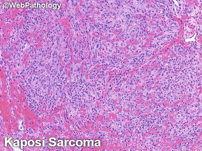 Angiolipoma : Differential Diagnosis