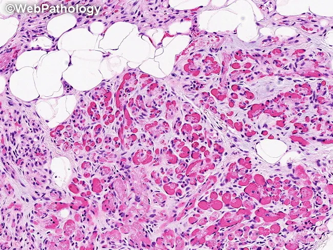 Angiolipoma : References