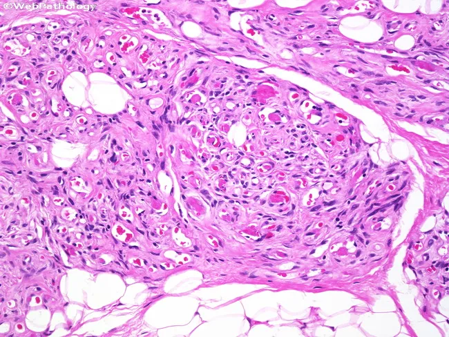 Angiolipoma : Additional Image