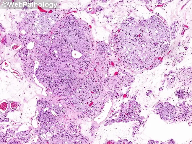 Chondroid Lipoma : Microscopic Features