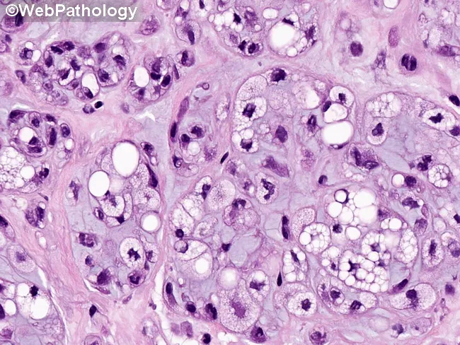 Chondroid Lipoma : Microscopic Features