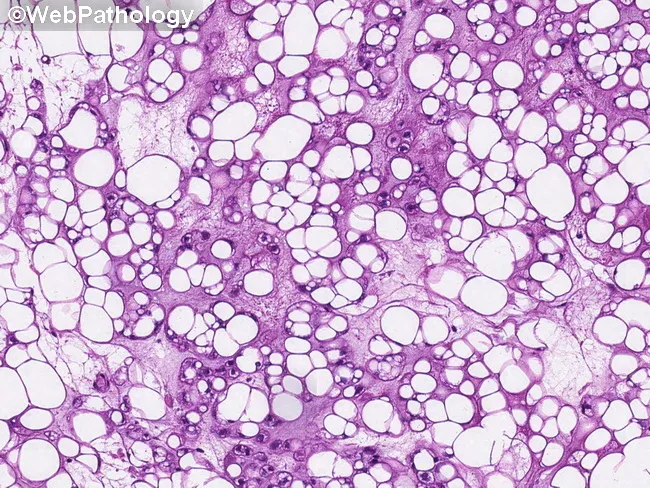 Chondroid Lipoma : Microscopic Features