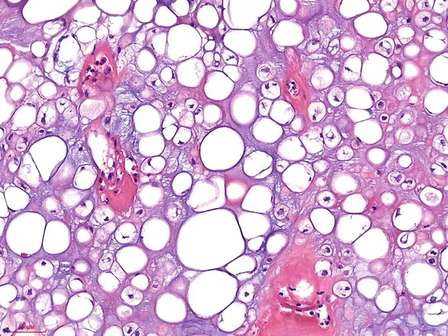 Chondroid Lipoma : Microscopic Features