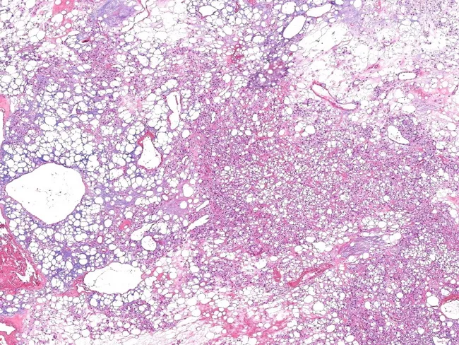 Chondroid Lipoma : Immunohistochemistry